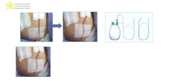 Patient Instruction for Total mastectomy or Modified Radical Mastectomy ...