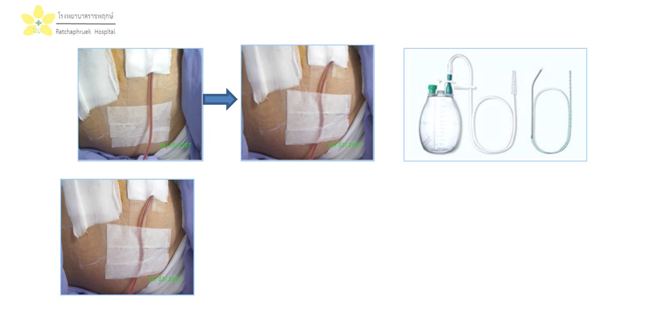 Patient Instruction for Total mastectomy or Modified Radical Mastectomy ...